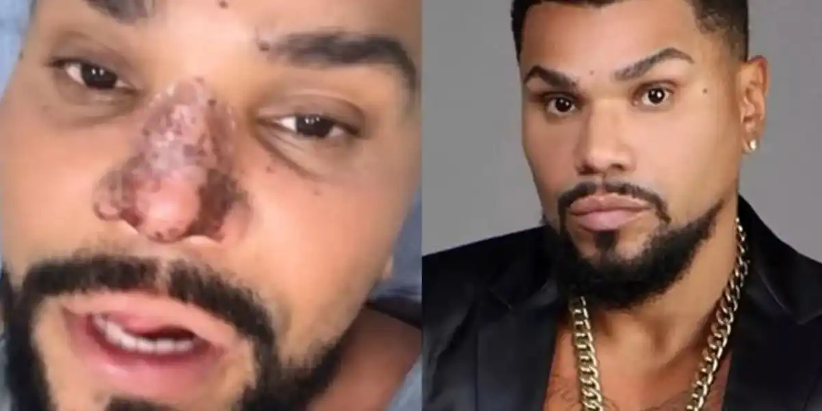 Naldo tem princípio de necrose no nariz após fazer rinomodelação ...