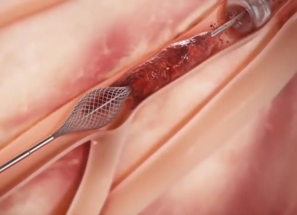 Entenda o Megavac, técnica de remoção de coágulos - Diário da Região